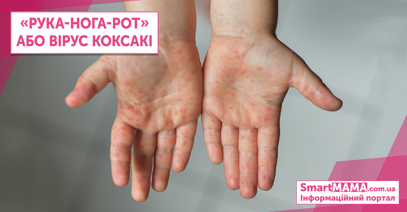 Вірус Коксакі. Симптоми та лікування. ФОТО | Smart Mama 2025